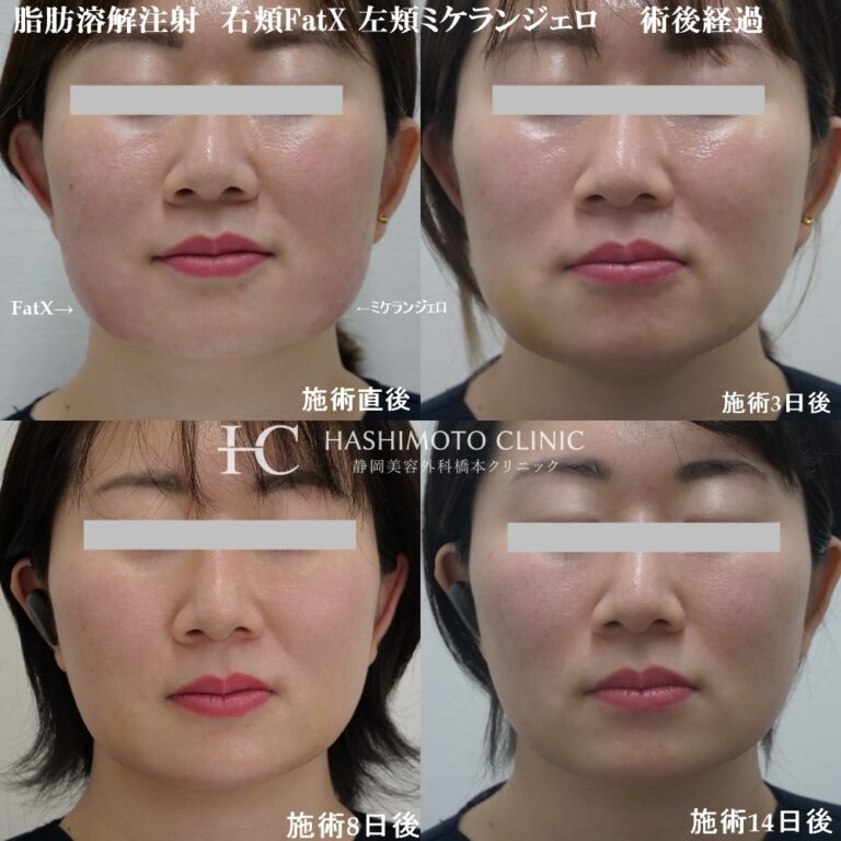 脂肪溶解注射のFATXcore とミケランジェロ比べてみた！（腫れや効果を） | 静岡美容外科 橋本クリニック 院長ブログ