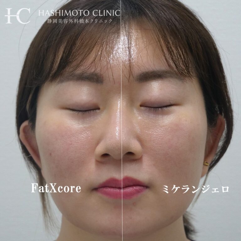 脂肪溶解注射のFATXcore とミケランジェロ比べてみた！（腫れや効果を） | 静岡美容外科 橋本クリニック 院長ブログ